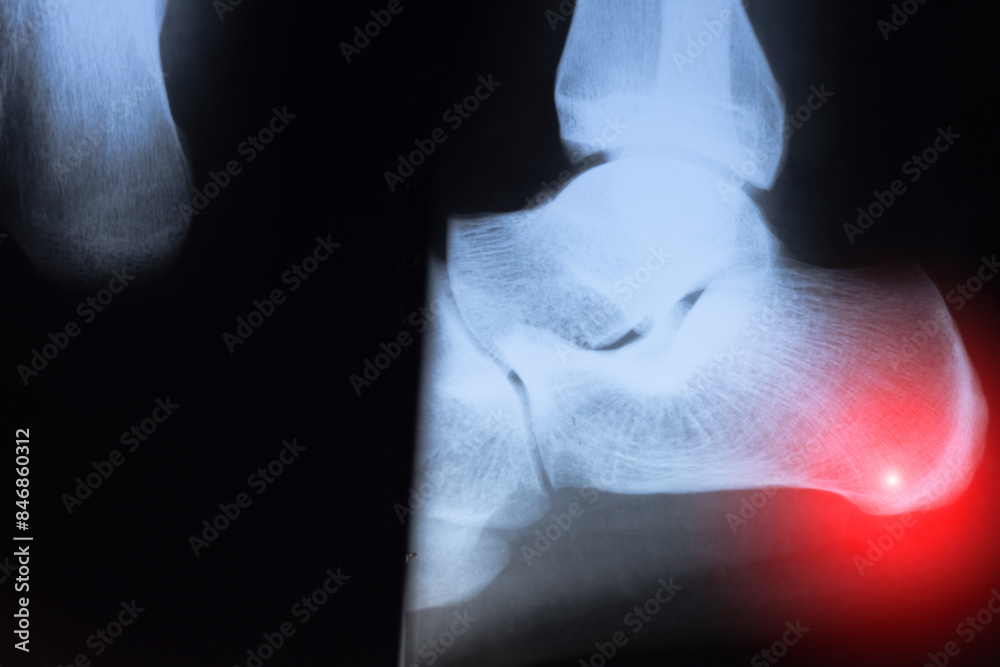 X-ray scan of Calcaneus.or heel bone destruction. Bone of the tarsus of ...