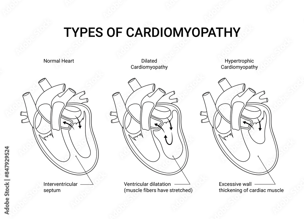 Types of cardiomyopathy sketch illustration medical design Stock Vector ...