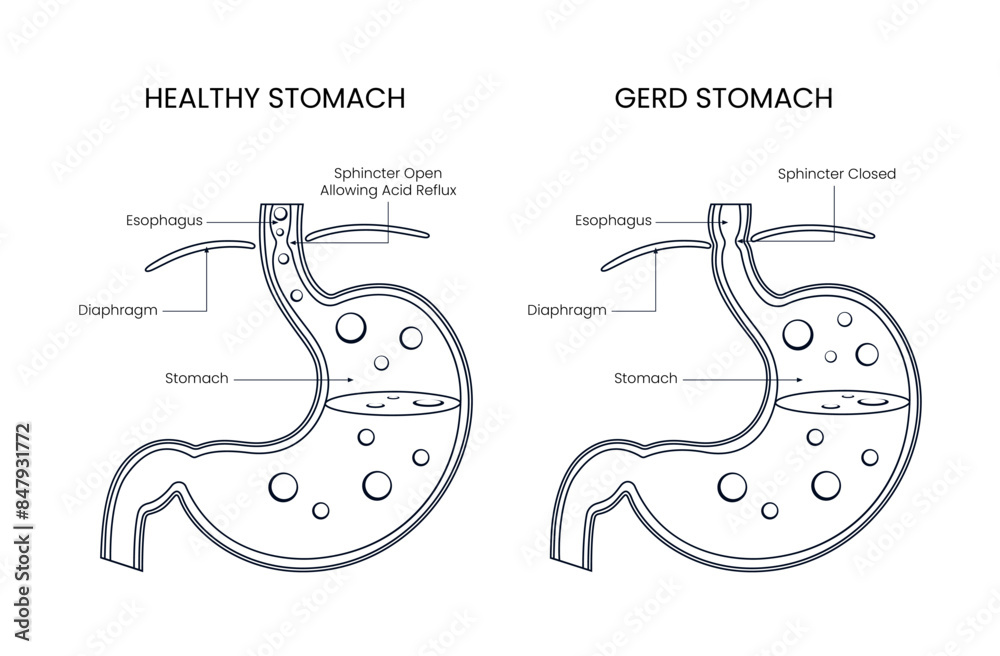 Diagram of gerd stomach disease with design line style for medical ...