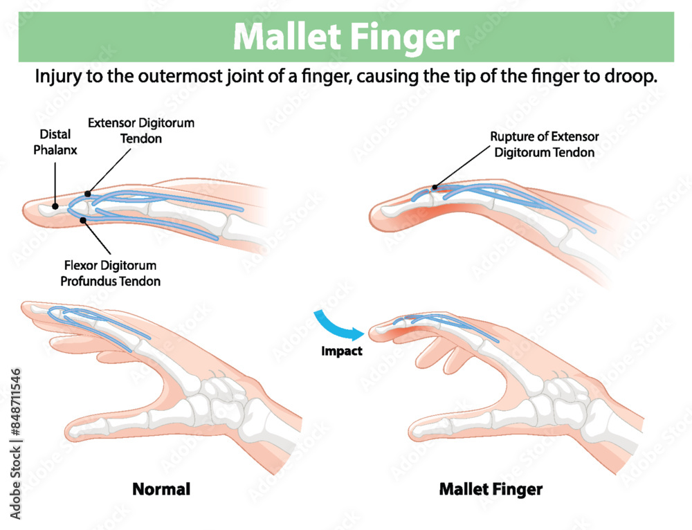 Diagram showing normal and mallet finger conditions Stock Vector ...