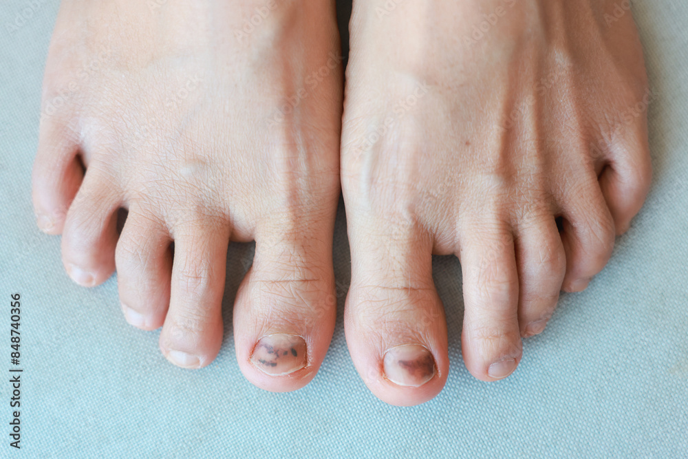 Subungual Hematoma on toenail are injuries of wearing shoes that are ...