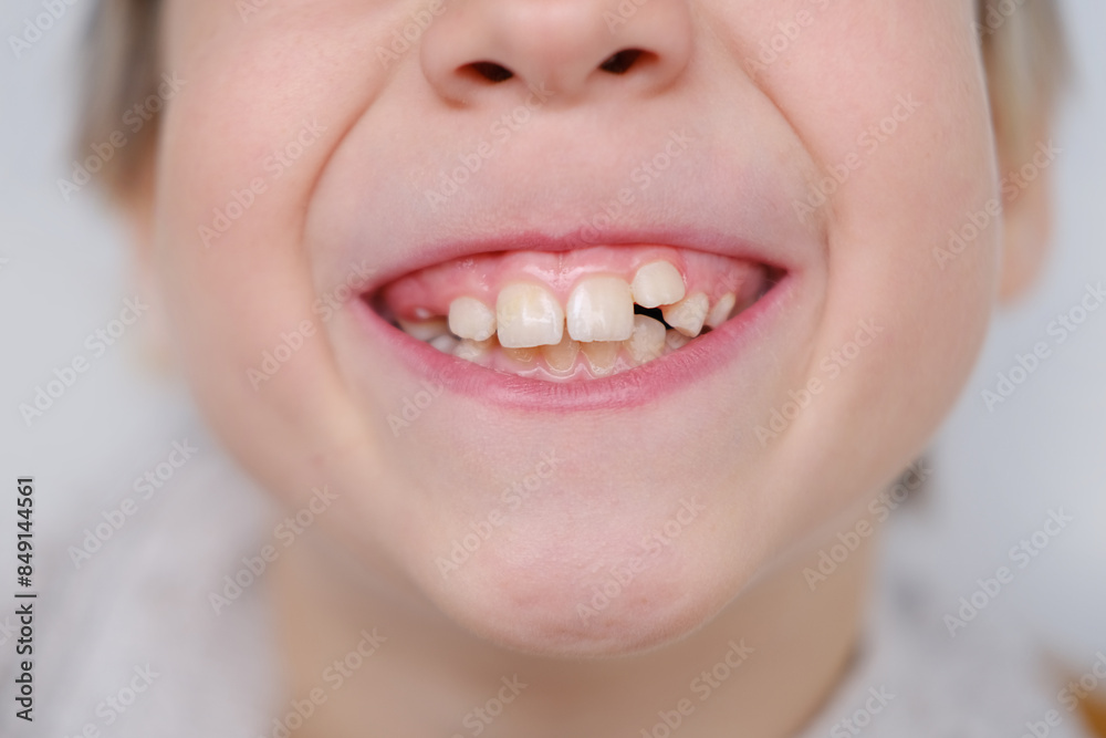 Young Smiling child, boy, age 10 reveals growing teeth, marking ...