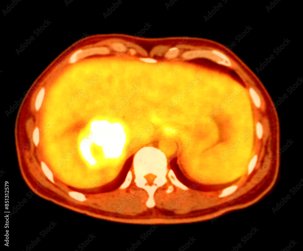 A PET CT scan reveals cholangiocarcinoma with suspected metastatic involvement of the lungs and ...