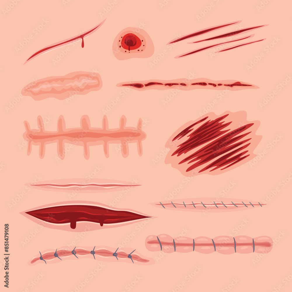 Set of Bloody wounds. Scars, surgical stitches and bruis, skin cuts, vector isolated set ...