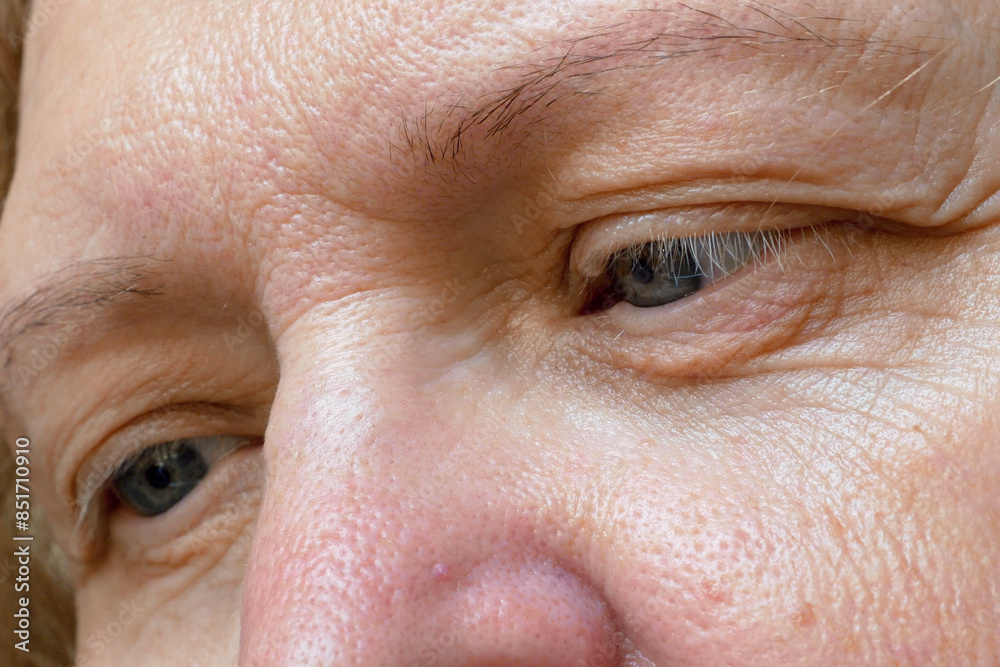 middle aged female's face with drooping eyelid eyes. Ptosis is a ...