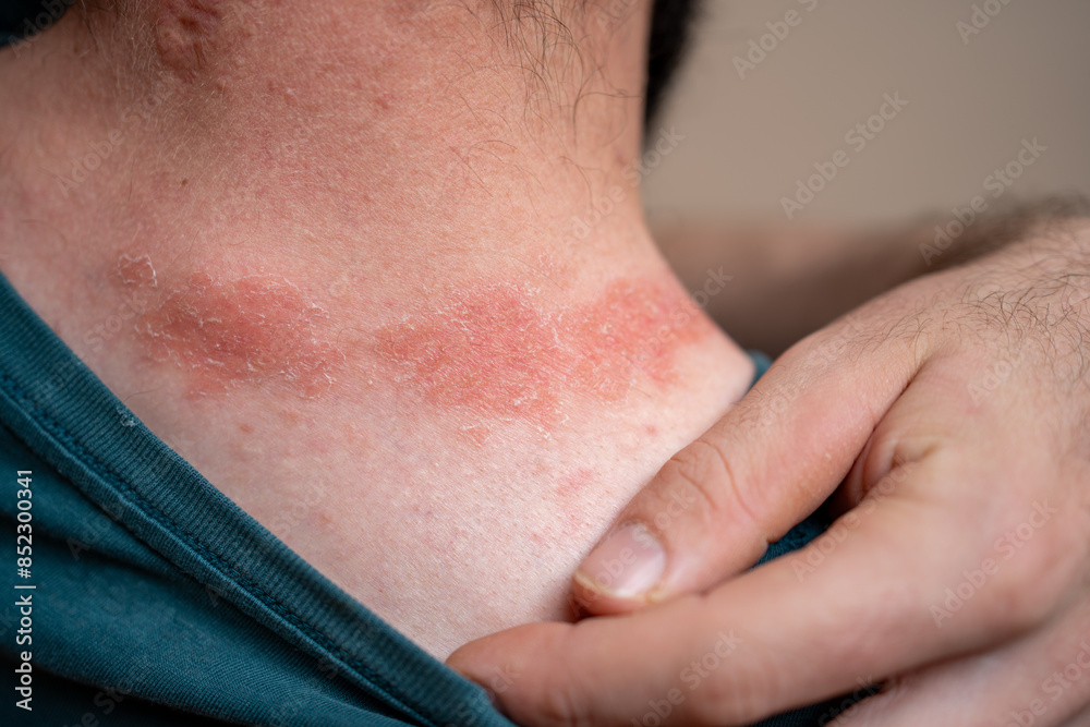 young man with skin spots around the neck. illness, diseases, allergies ...