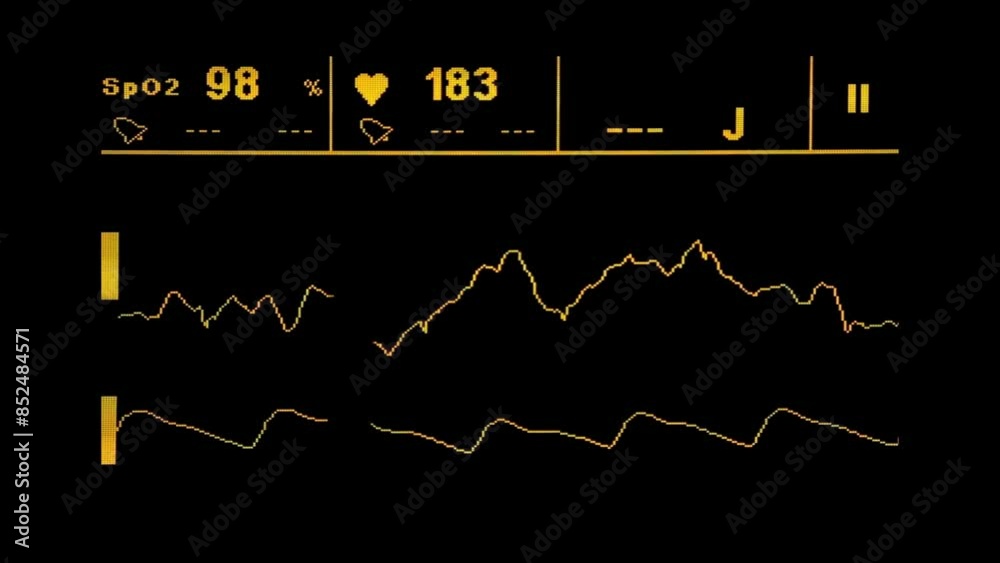 EKG Heartbeat reading animation on black background in 4K. Medical ...