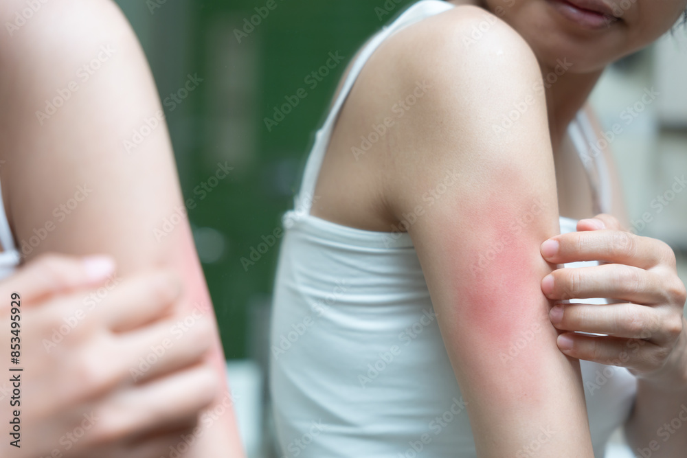 skin problem and beauty. Young woman scratch body has itchy skin from ...