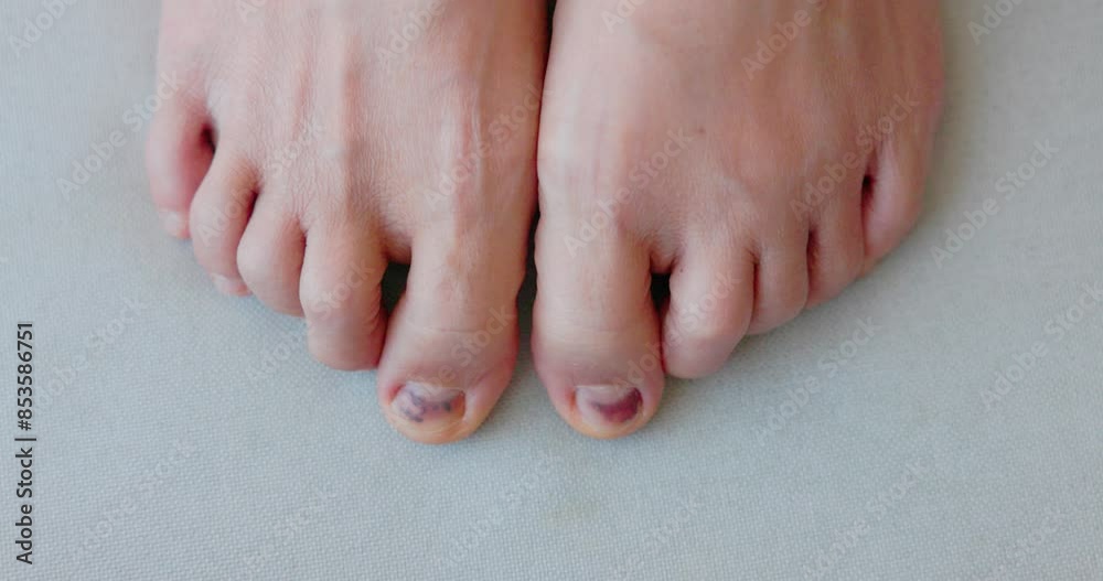 Subungual Hematoma on toenail are injuries of wearing shoes that are ...