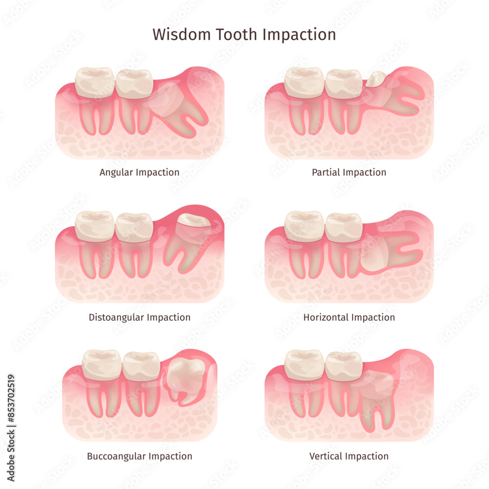 Wisdom tooth. Wisdoms teeth dental problem, molar extraction root canal ...