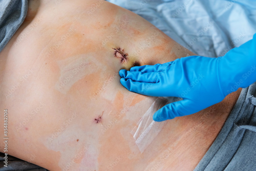 Hands of medic or nurse in blue gloves examining a fresh suture on a ...