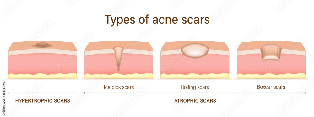 Vetor de Types of acne scars. Facial skin problems. Hypertrophic scars ...