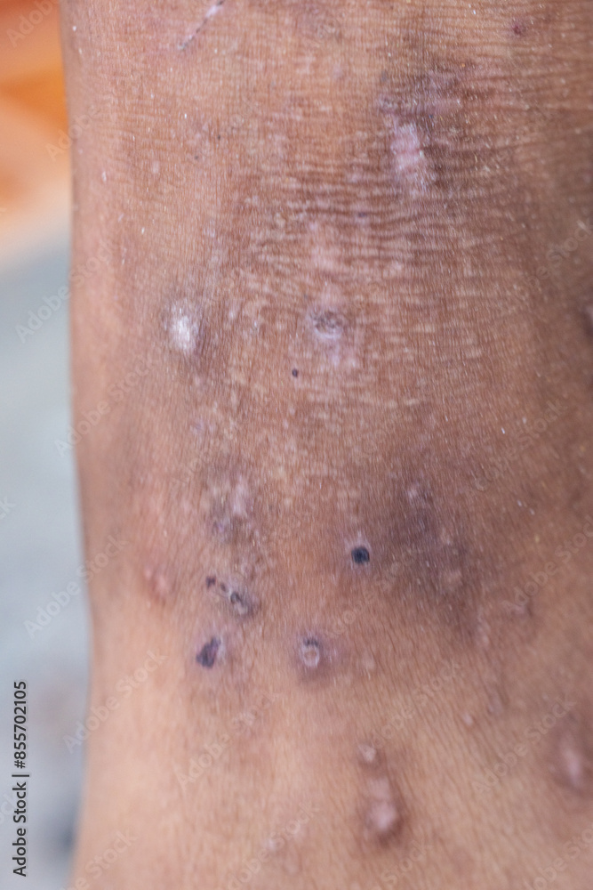 Background image of wounds caused by Systemic Lupus erythematosus (SLE ...