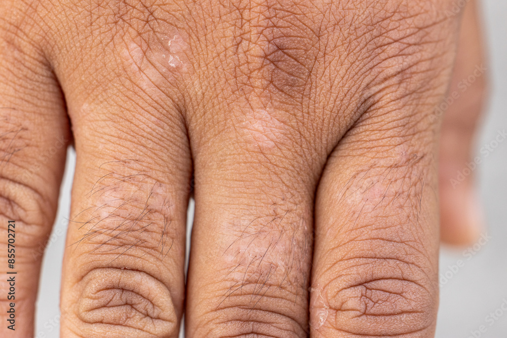 Background image of wounds caused by Systemic Lupus erythematosus (SLE ...