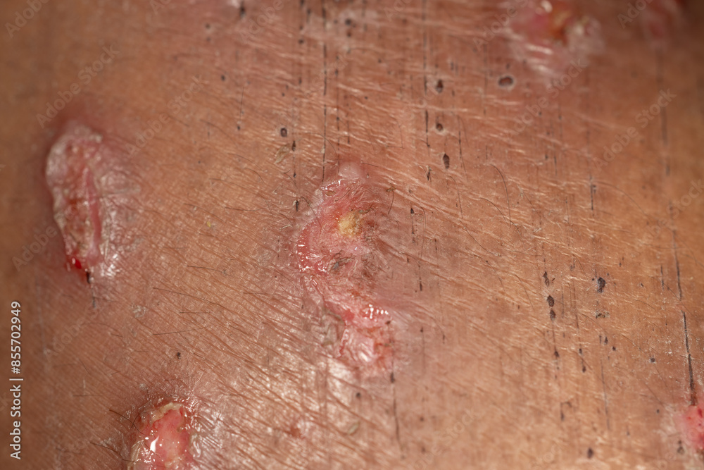 Background image of wounds caused by Systemic Lupus erythematosus (SLE ...