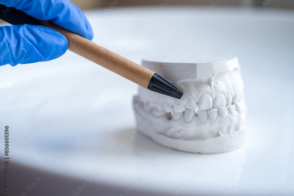 White plaster impression of the dental jaw of a patient with crooked ...
