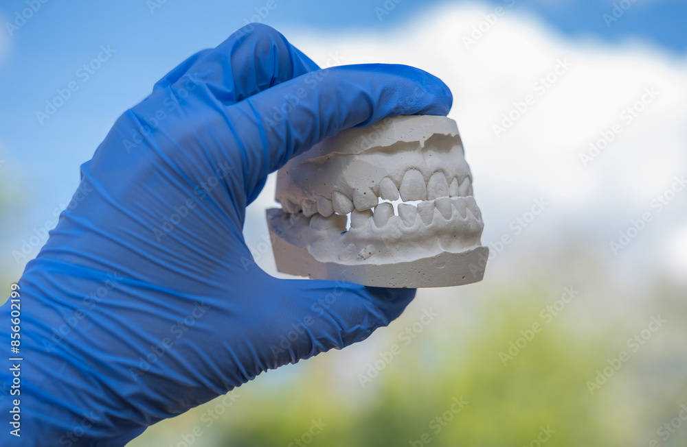 White plaster impression of the dental jaw of a patient with crooked ...