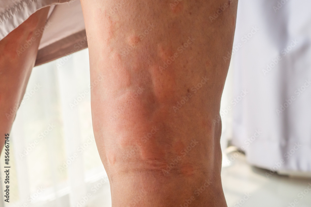 Young asian man has allergic skin rash on his legs from itchy dry skin ...
