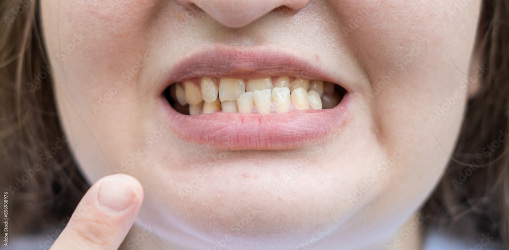 Patient with dislocated jaw and malocclusion, temporomandibular joint ...