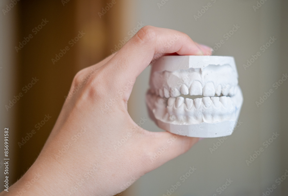 White plaster impression of the dental jaw of a patient with crooked ...