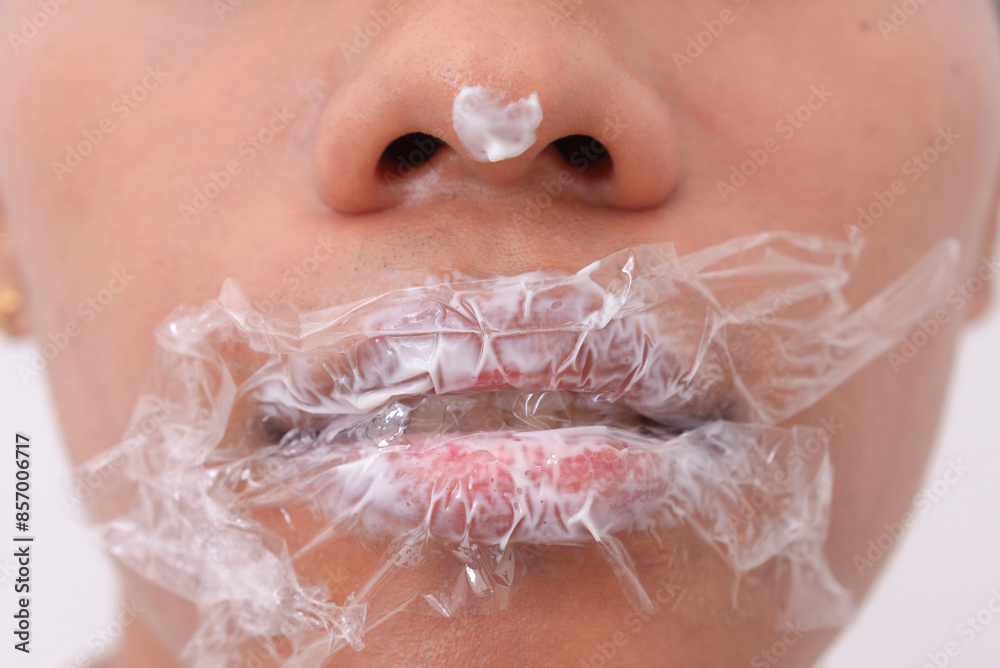 Nose and lip area of a man applied with topical numbing cream or ...