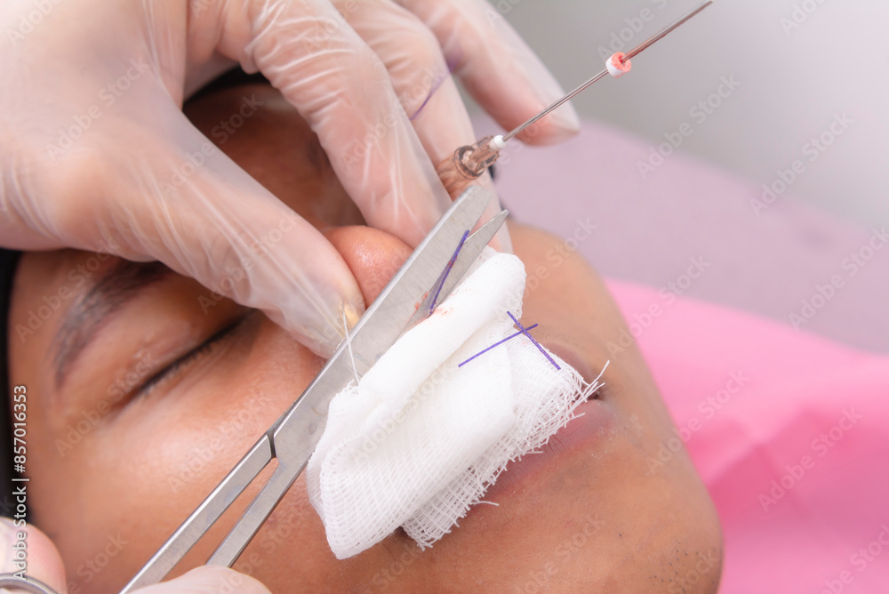 Cutting excess PDO thread with scissors. Plastic surgeon performing a ...