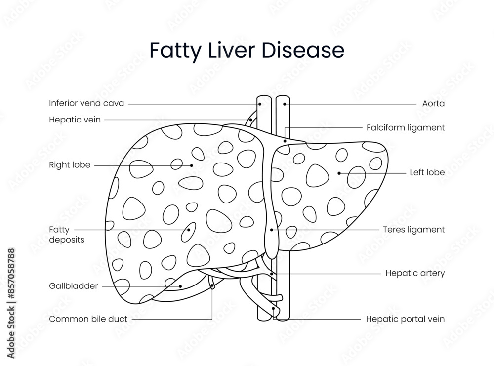Plakát Diagram of fatty liver disease with line style – Obraz na Zeď ...