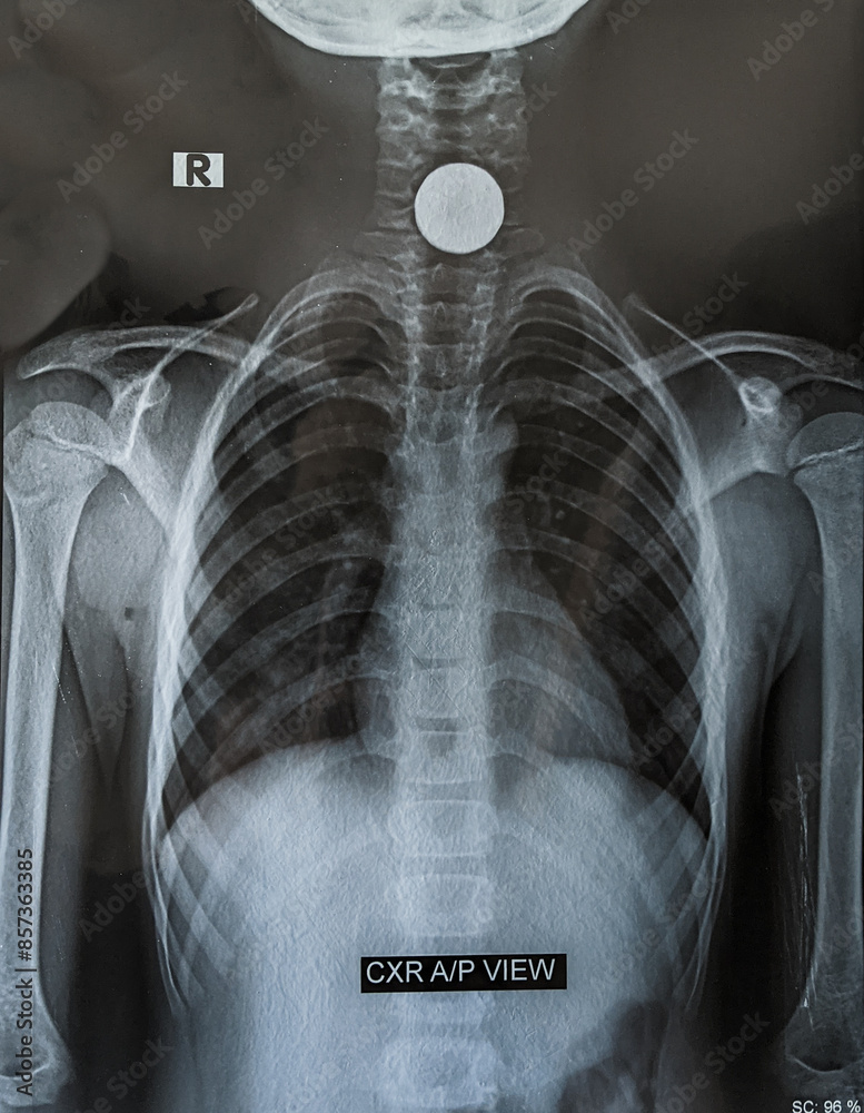 x ray image of chest showing circular coin in oesophagus Stock Photo ...