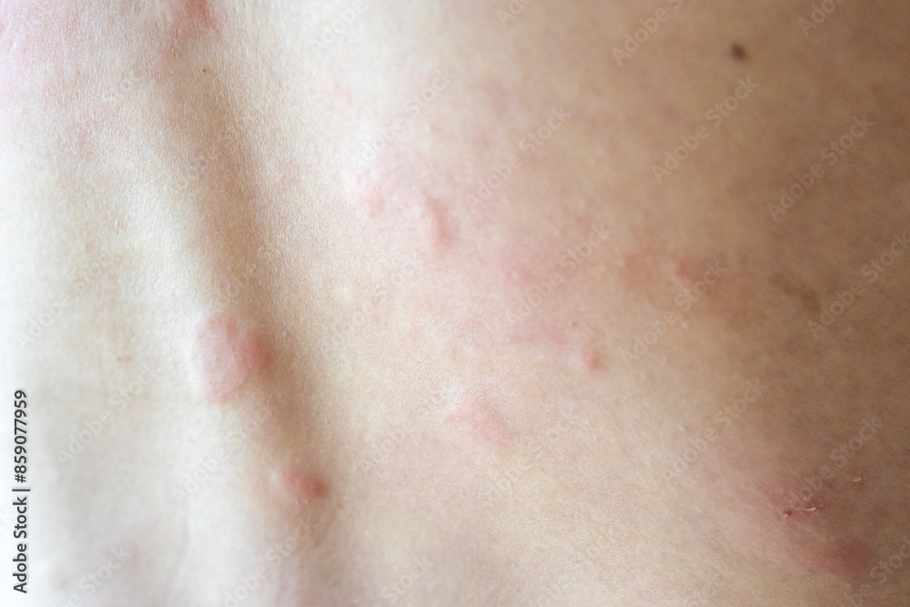 Young asian man itching and scratching on his back from allergic itchy ...