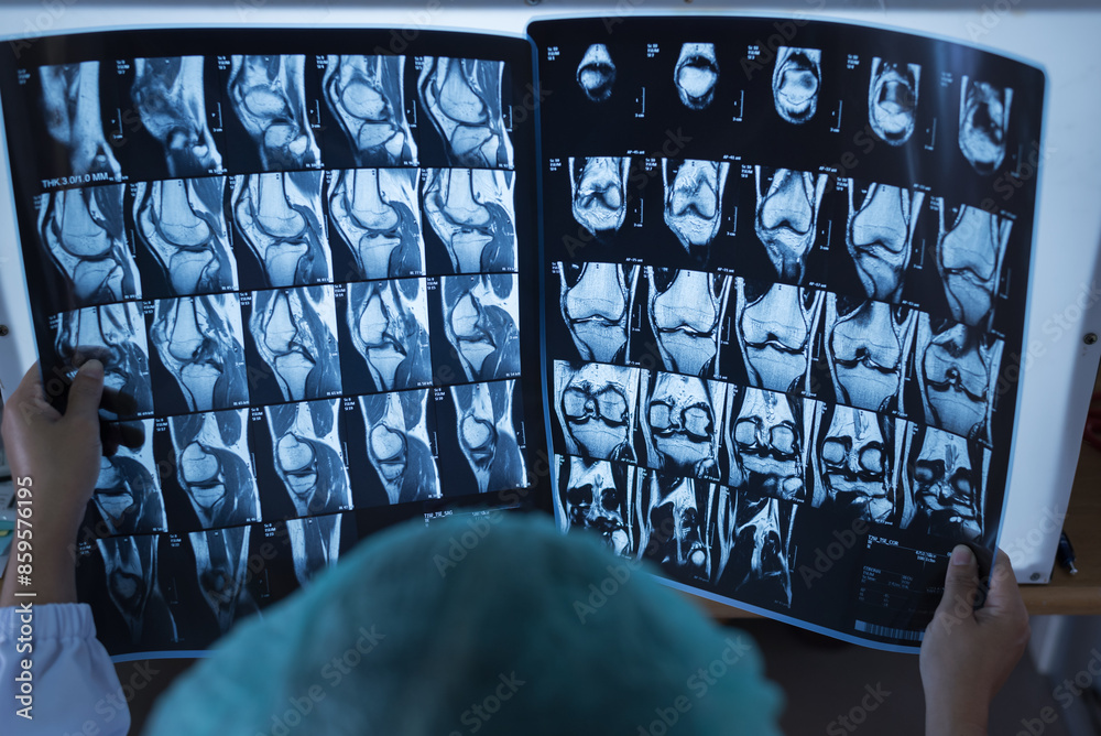 Foto de Patient bone x-ray film before surgery.Image MRI and CT scan at ...