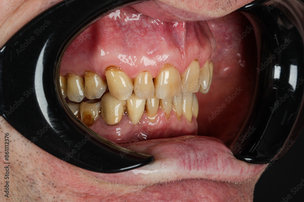 Wedge-shaped (cone-shaped) section of enamel loss in the area of the ...