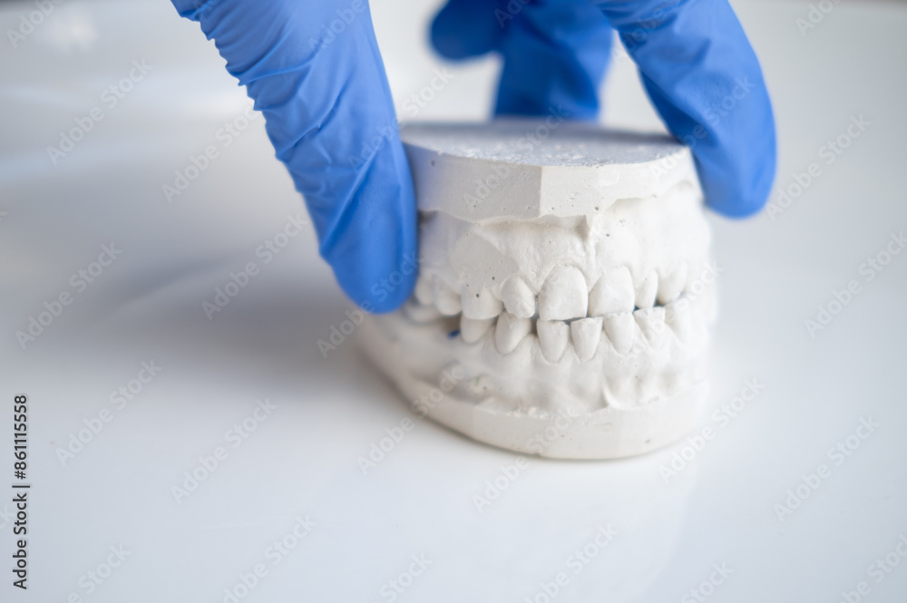 White plaster impression of the dental jaw of a patient with crooked ...