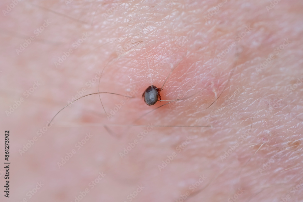 A tick on the skin that transmits dangerous diseases such as tick-borne ...