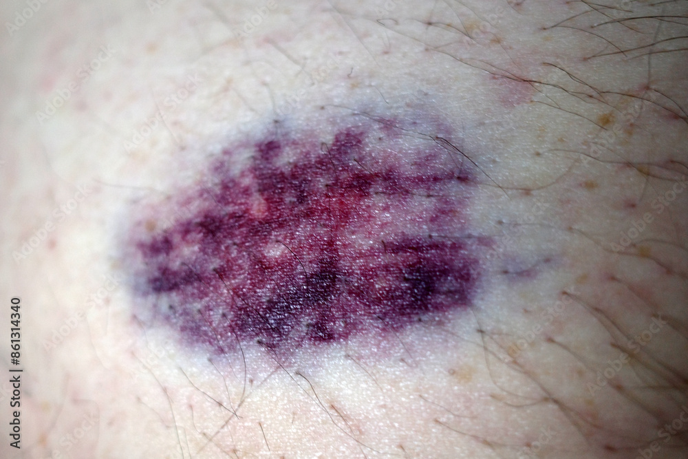 Hematoma as a result of injected heparin in the belly Stock Photo ...