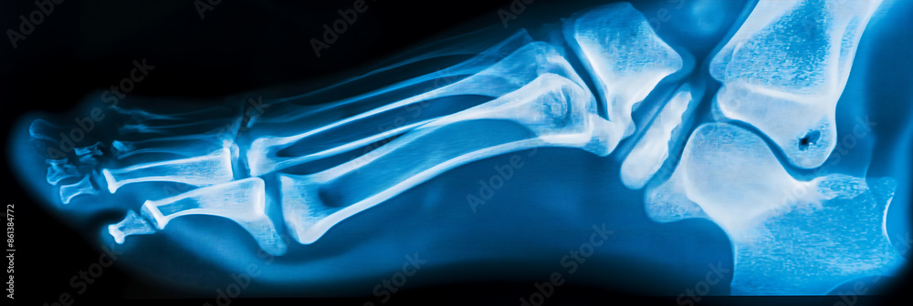 X-ray image of human foot highlighting bone structure medical imaging ...