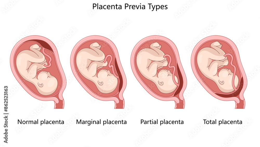 Plakat, Poster different types of placenta previa, showing normal ...