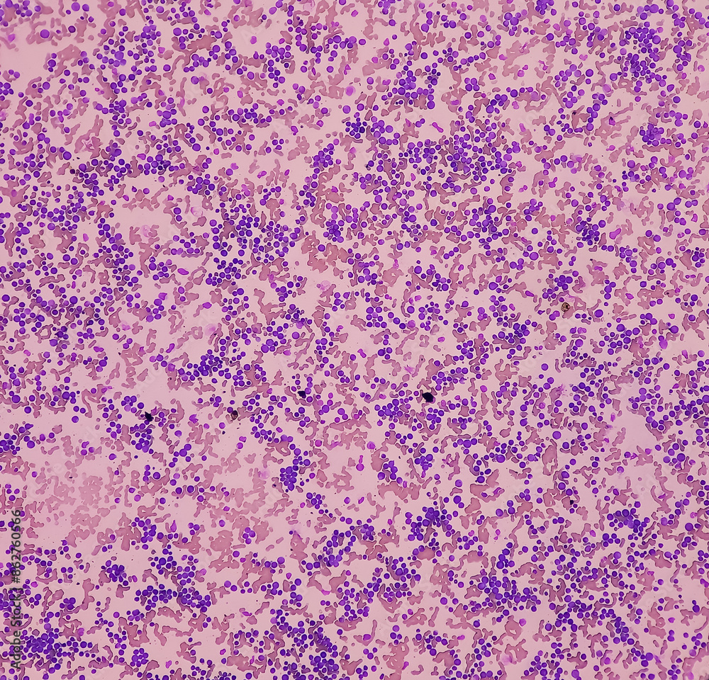 Acute myeloid leukemia (AML). Smear show monocytes and mostly blast ...