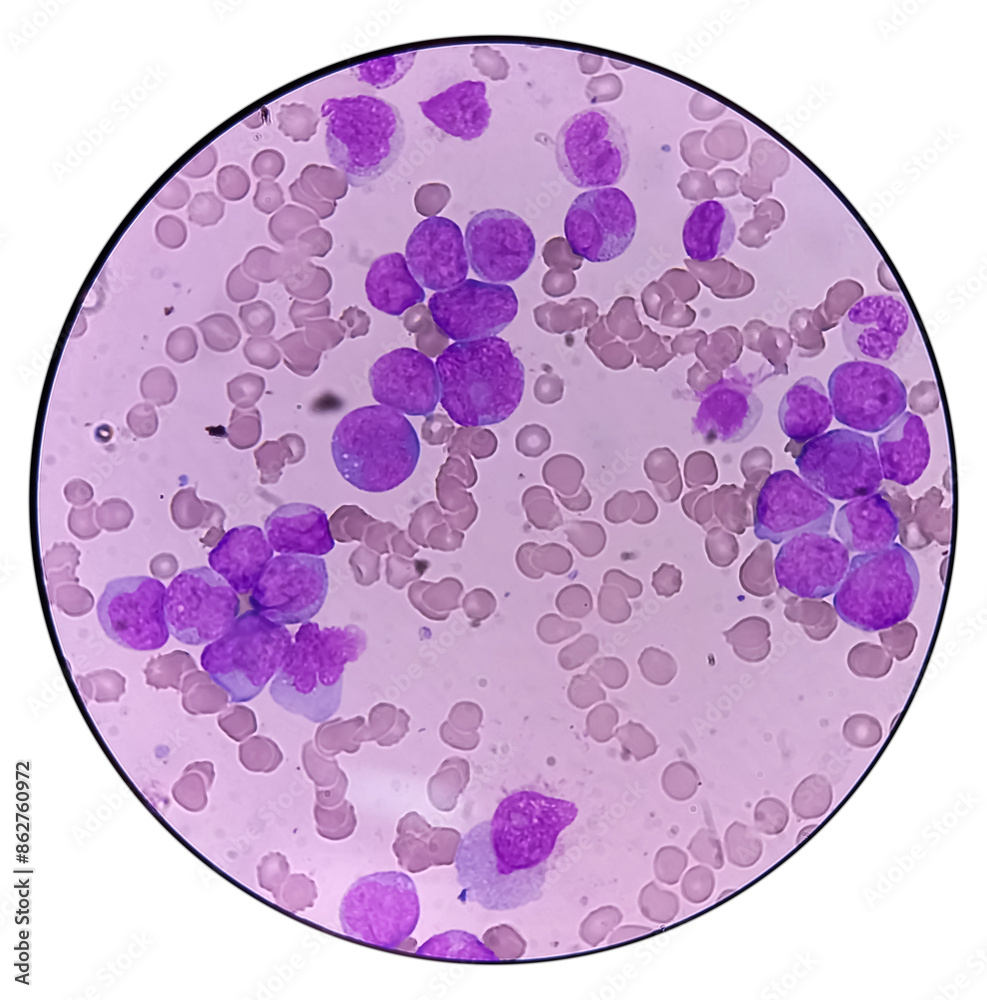 Acute myeloid leukemia (AML). Smear show monocytes and mostly blast ...