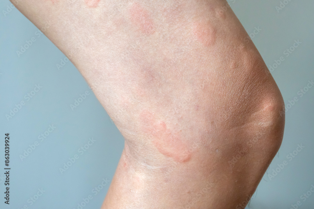 Young asian man has allergic skin rash on his legs from itchy dry skin ...