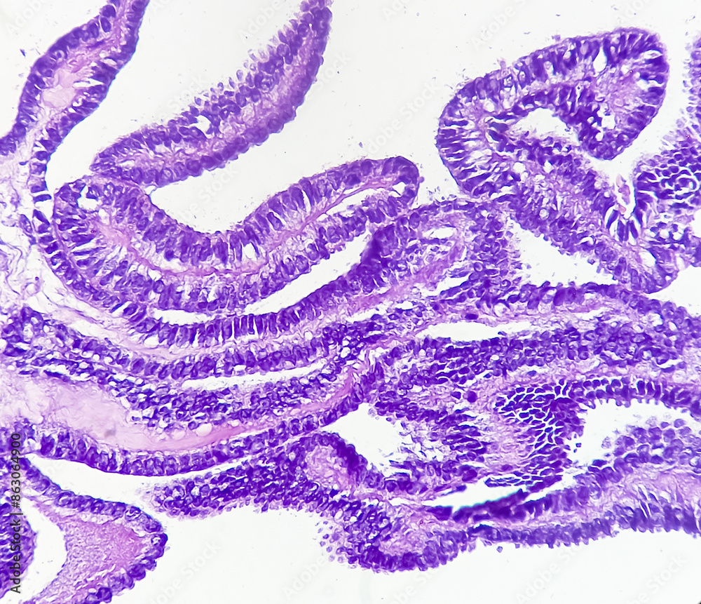 Microscopic image of Papillary borderline serous tumor of the ovary ...