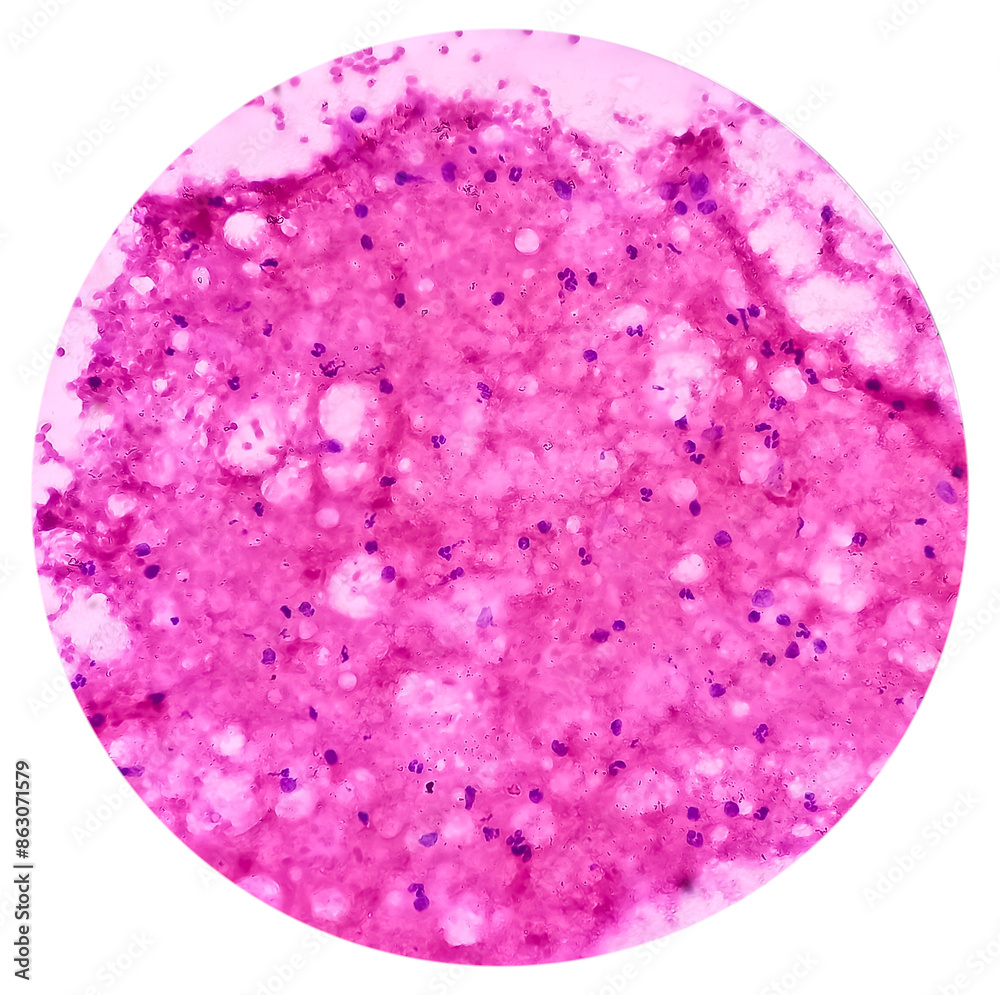 Photomicrograph of Osteolytic lesion of left proximal radium, Positive ...