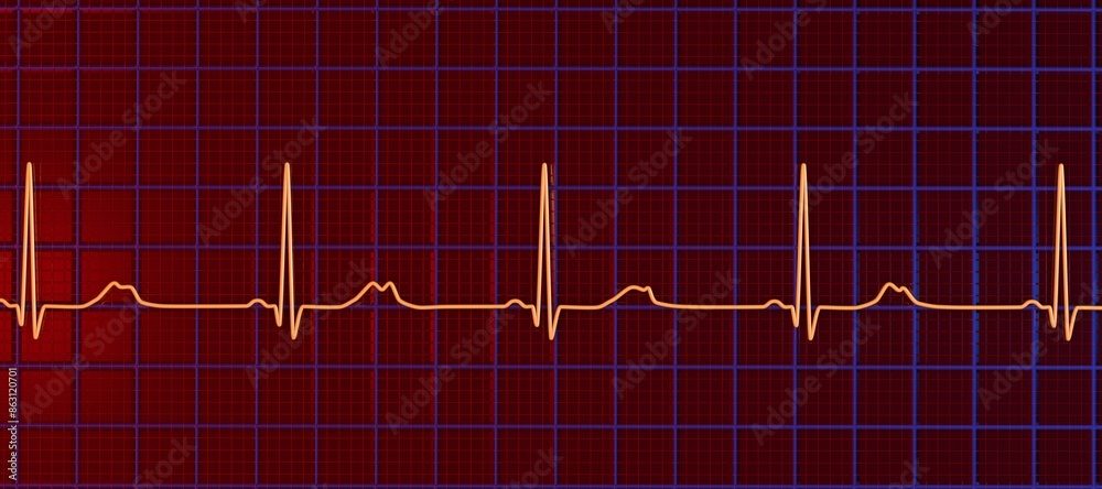 Long QT syndrome, type 2. 3D illustration of an electrocardiogram (ECG ...