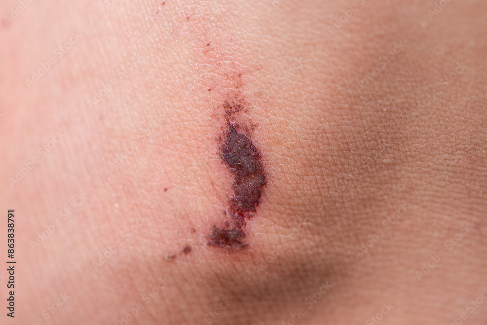 colseup of infected wound, healing process. Stock Photo | Adobe Stock