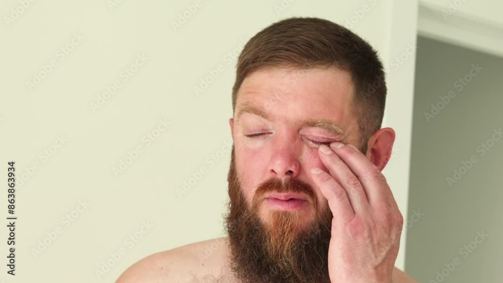 Male patient's infected eye. The blue-eyed bearded man staring at the ...