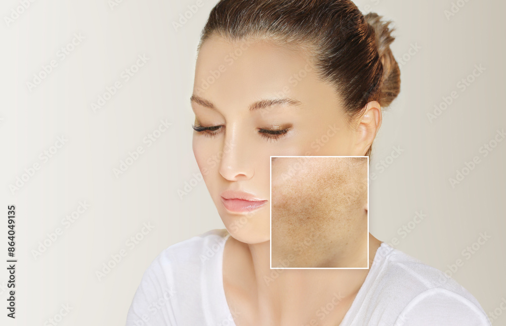 Dark spots, freckles,hyperpigmentation(melasma or chloasma),concept ...