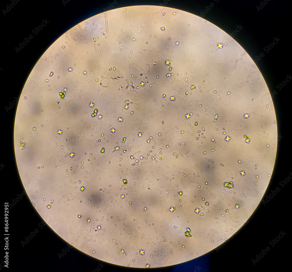 Calcium oxalate in urine sediment analysed by light microscope. Close ...