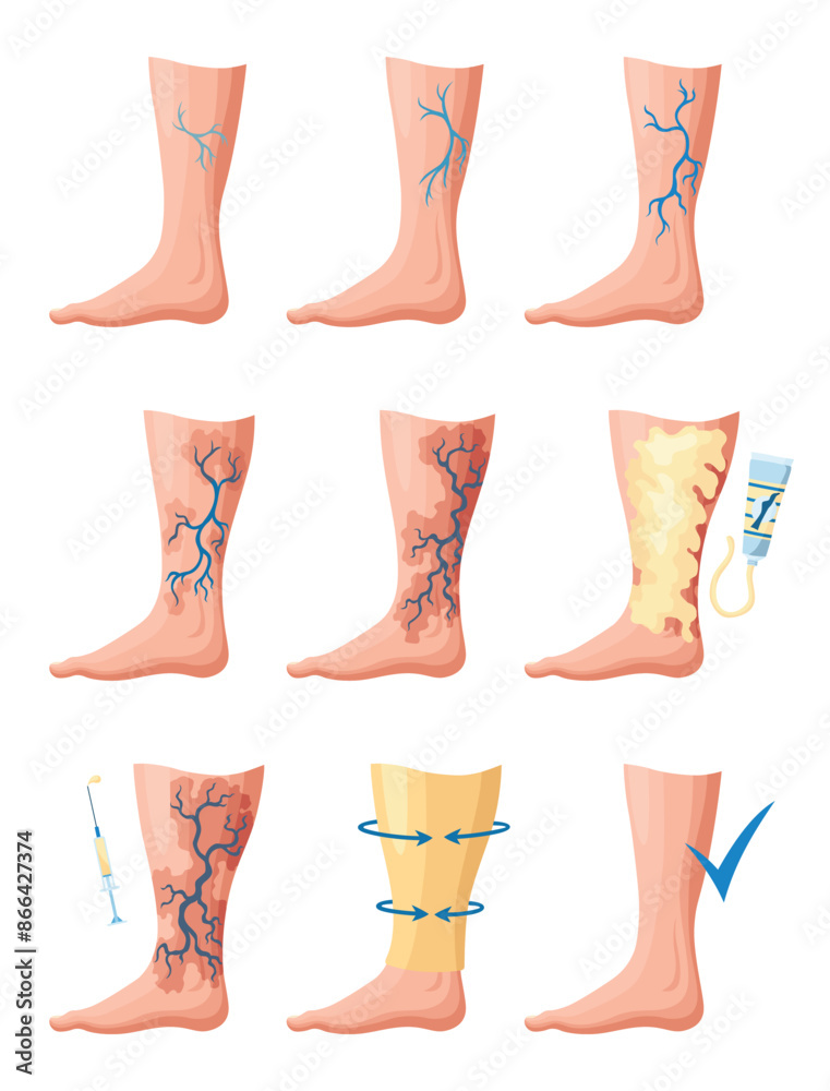 Stages or types of varicose veins development. Medical poster or ...