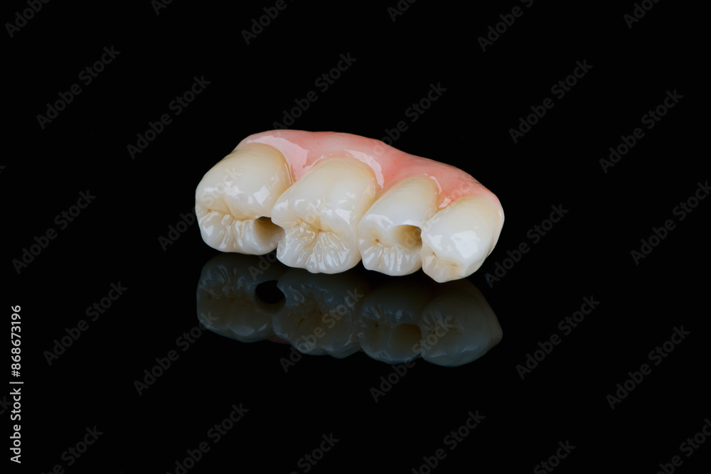 Dental bridge four teeth and artificial gum made of monolithic ...