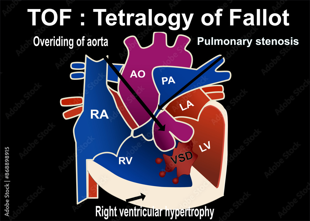 The picture show the structure of tetralogy of fallot that show the 4 ...