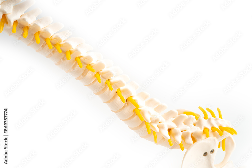 Póster Lumbar spine displaced herniated disc fragment, spinal nerve and ...